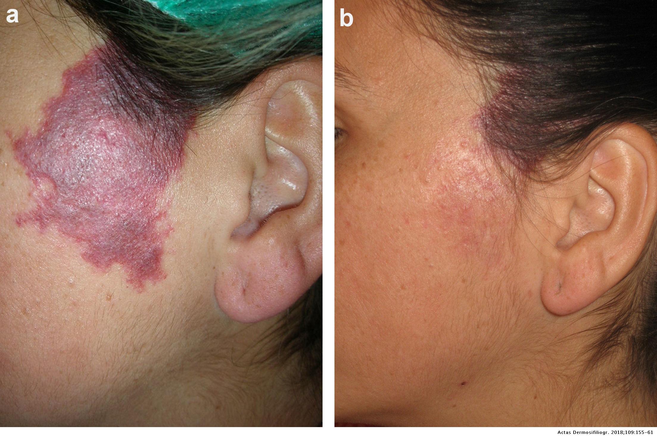 لیزر پی دی ال چیست؟درمان ضایعات عروقی و پوستی چگونه با لیزر PDL انجام ...